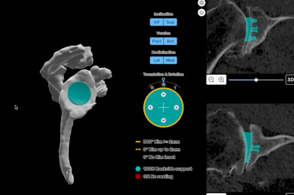 Glenoid Loosening After Total Shoulder Replacement - James Andry, MD